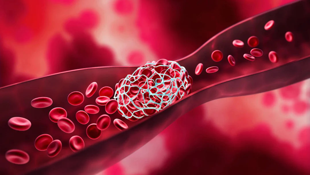 Deep Vein Thrombosis (DVT): Key Causes and Practical Help – HealthAid®